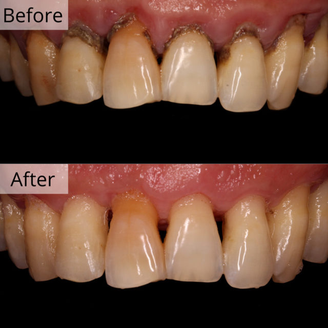 Periodontal Therapy - MINISH Dental Hospital