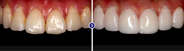 Orthodontic Treatment - MINISH Dental Hospital