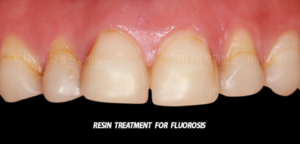 What Are The White Spots On My Teeth & How To Treat Them