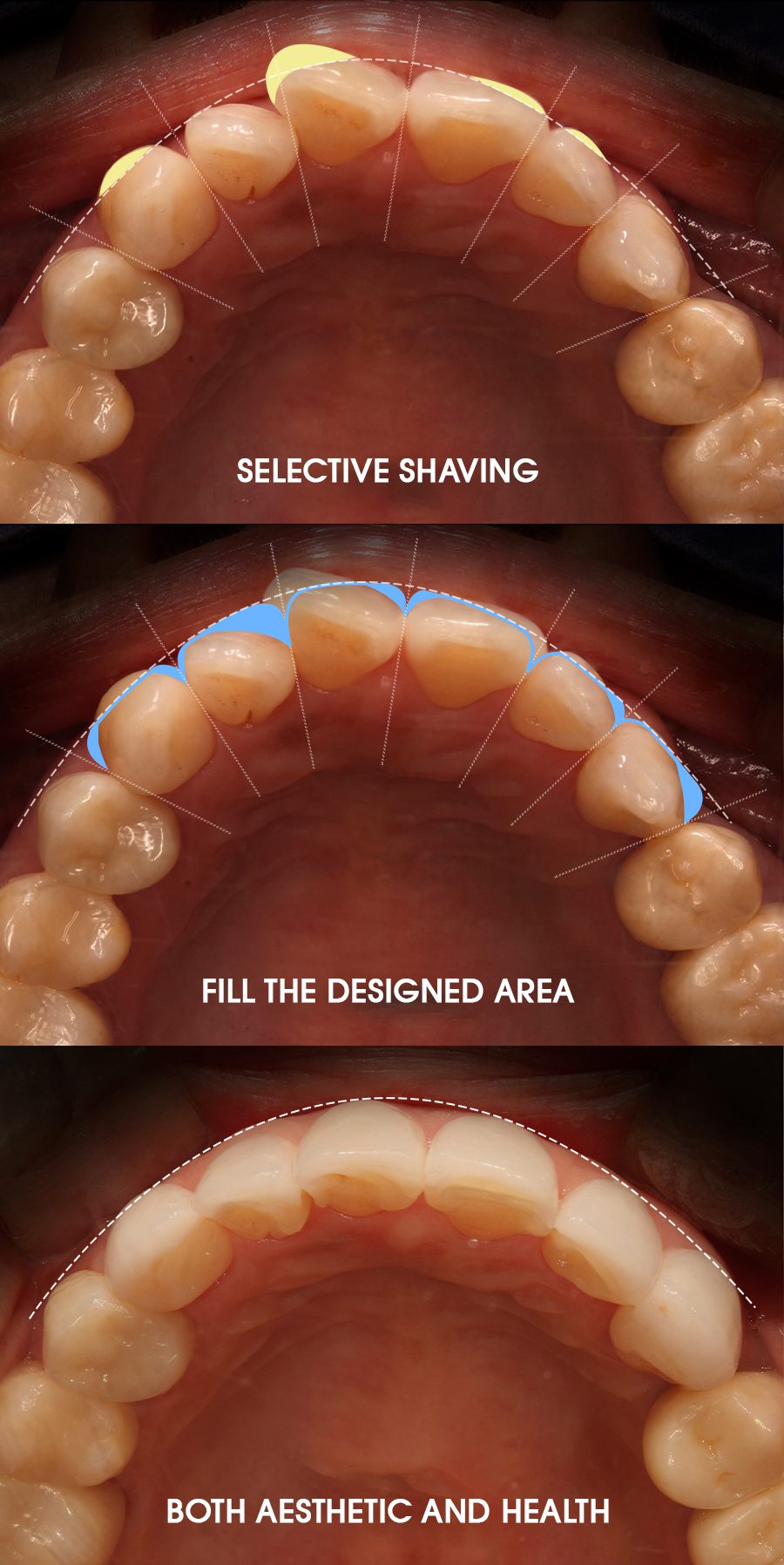 How Can I Get Perfect Teeth Alignment - (Dasha Taran)