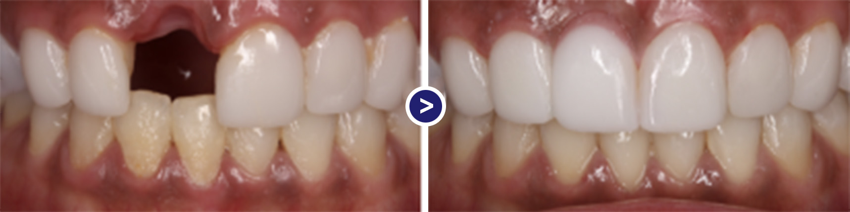 Minish Veneers in Korea | English Speaking Veneer Dental Clinic