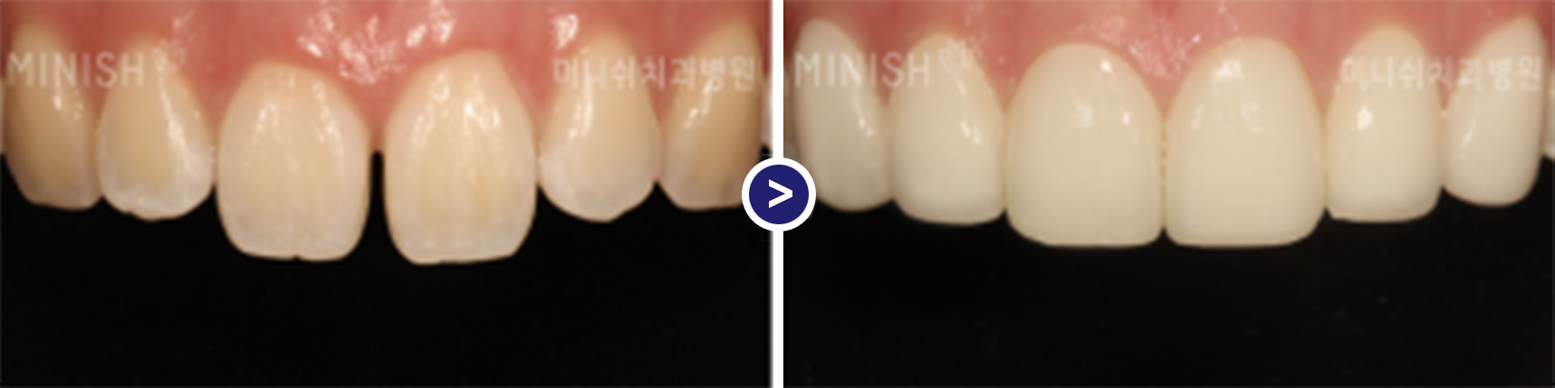Minish Veneers in Korea | English Speaking Veneer Dental Clinic