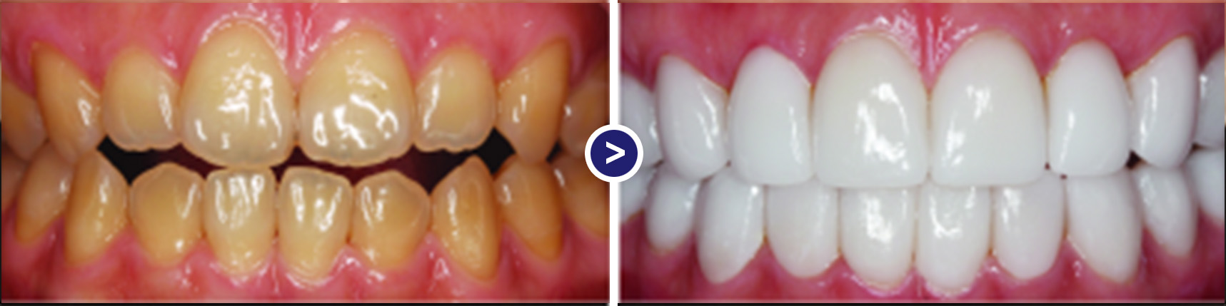 Minish Veneers in Korea | English Speaking Veneer Dental Clinic