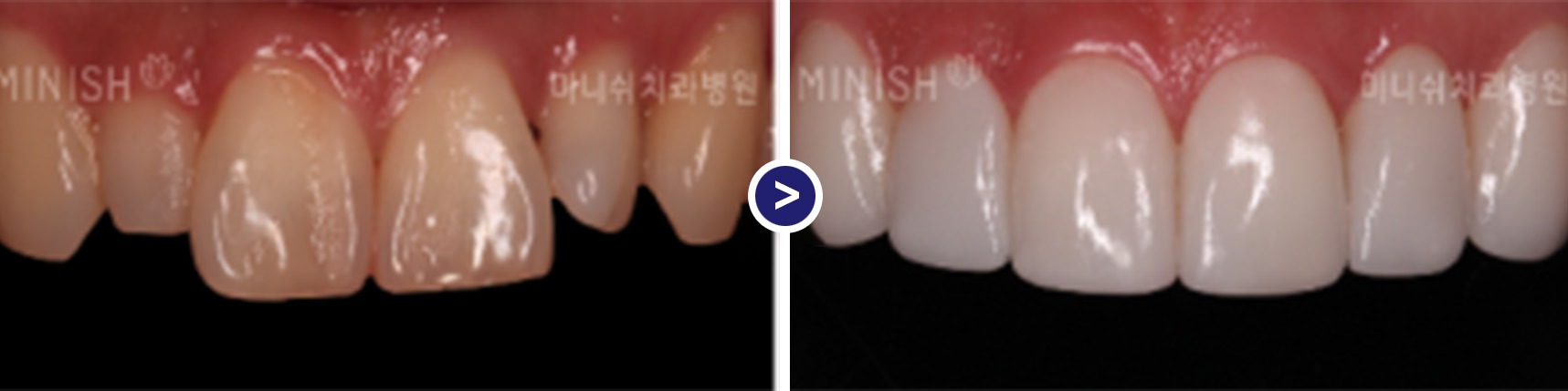 Minish Veneers in Korea | English Speaking Veneer Dental Clinic