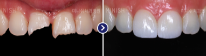 Before and After - Minish Dental Hospital