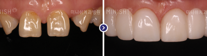 Before and After - Minish Dental Hospital