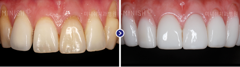 Get Veneers in Korea | English Speaking Veneer Dental Clinic